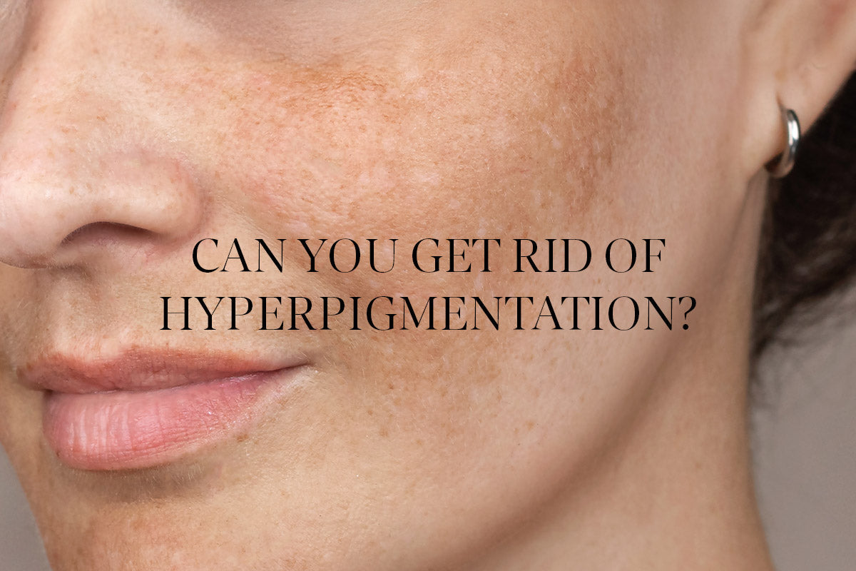 Can You Get Rid of Hyperpigmentation? – The Skin Diary